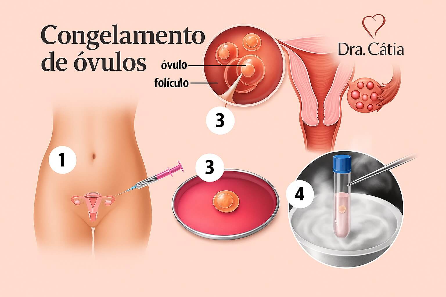 Congelamento de Óvulos nos Tempos Atuais: O Que Toda Mulher Precisa Saber - Dra Cátia Pessanha